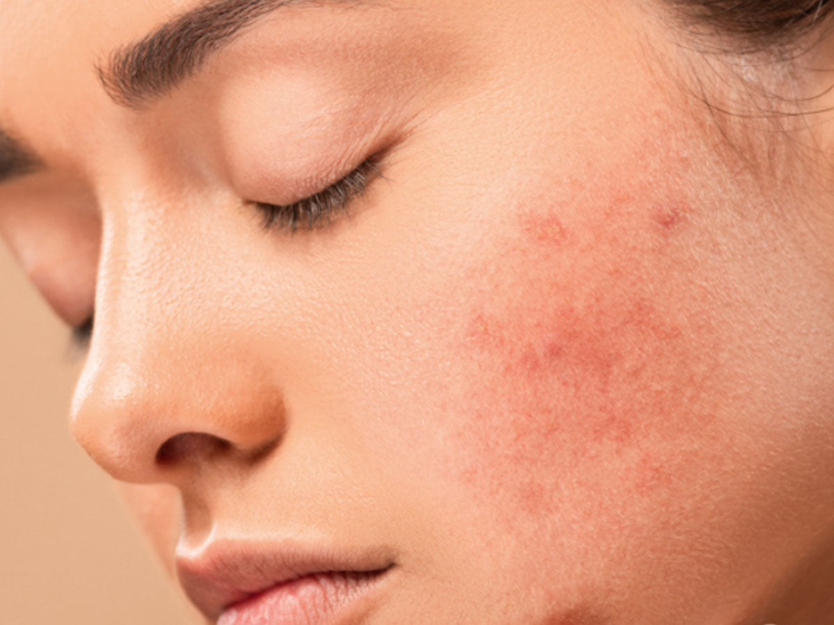 Acne Awareness Month | Clear Skin Solutions | Environ Skincare